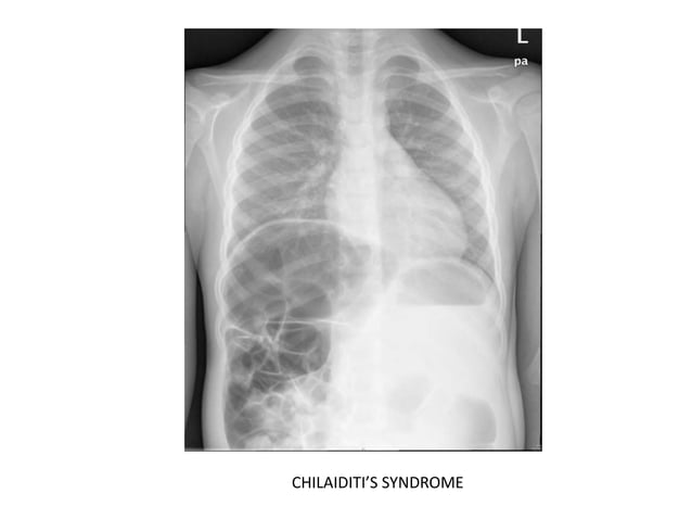 X Rays: chest injury, abdomen- bowel obstruction & perforation, KUB &IVP