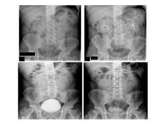 X Rays: chest injury, abdomen- bowel obstruction & perforation, KUB ...