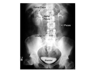 X Rays: chest injury, abdomen- bowel obstruction & perforation, KUB ...