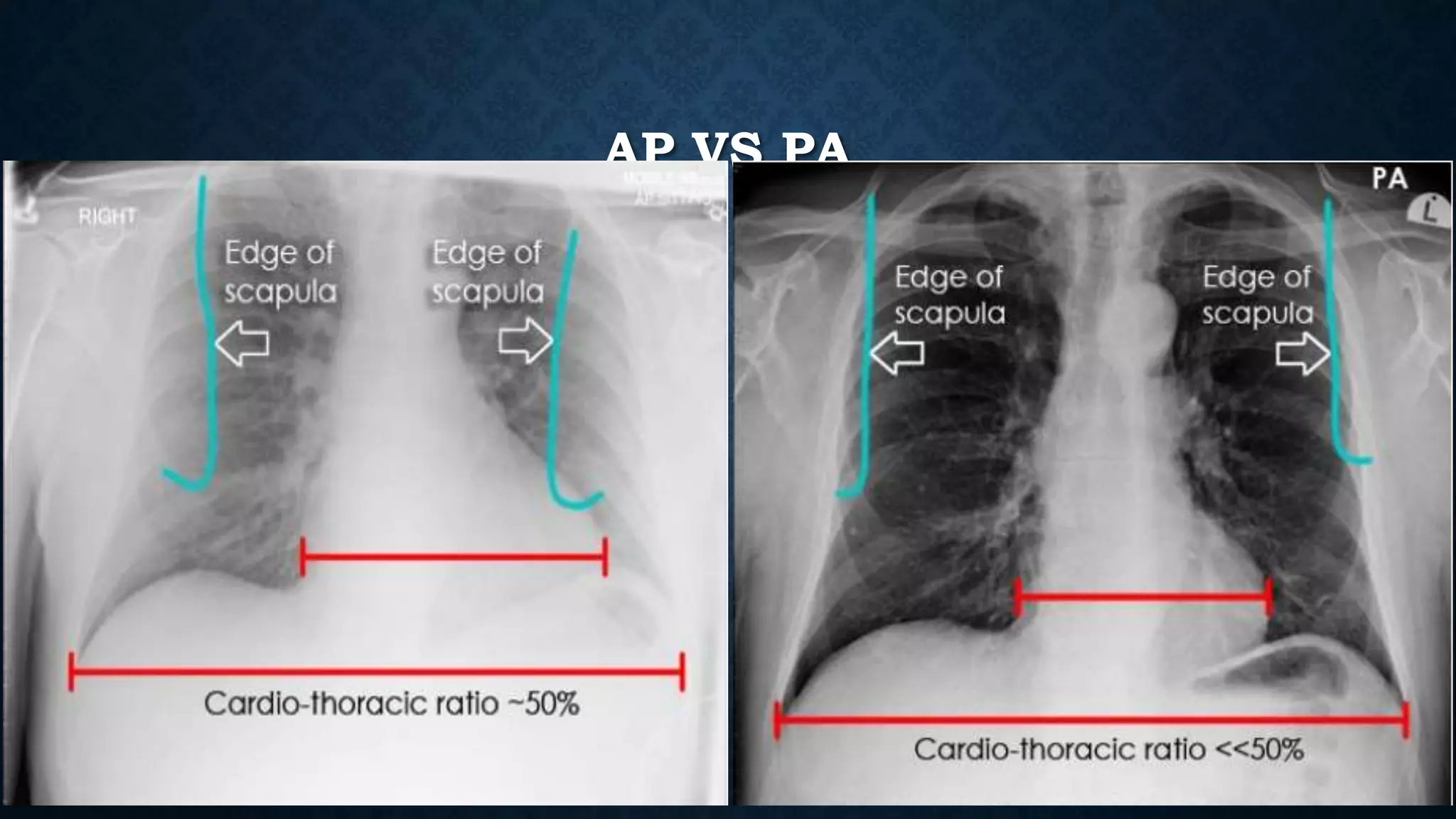 Xrays / CHEST/ABDOMIN./ BASIC .pptx