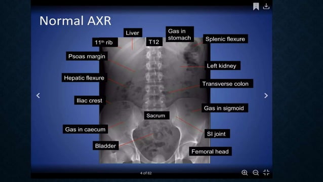 Xrays / CHEST/ABDOMIN./ BASIC .pptx