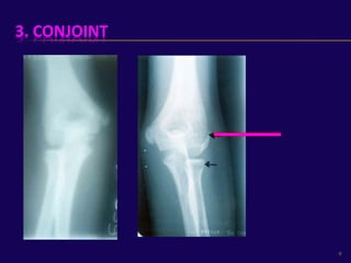 X-ray identification of bones for forensic | PDF