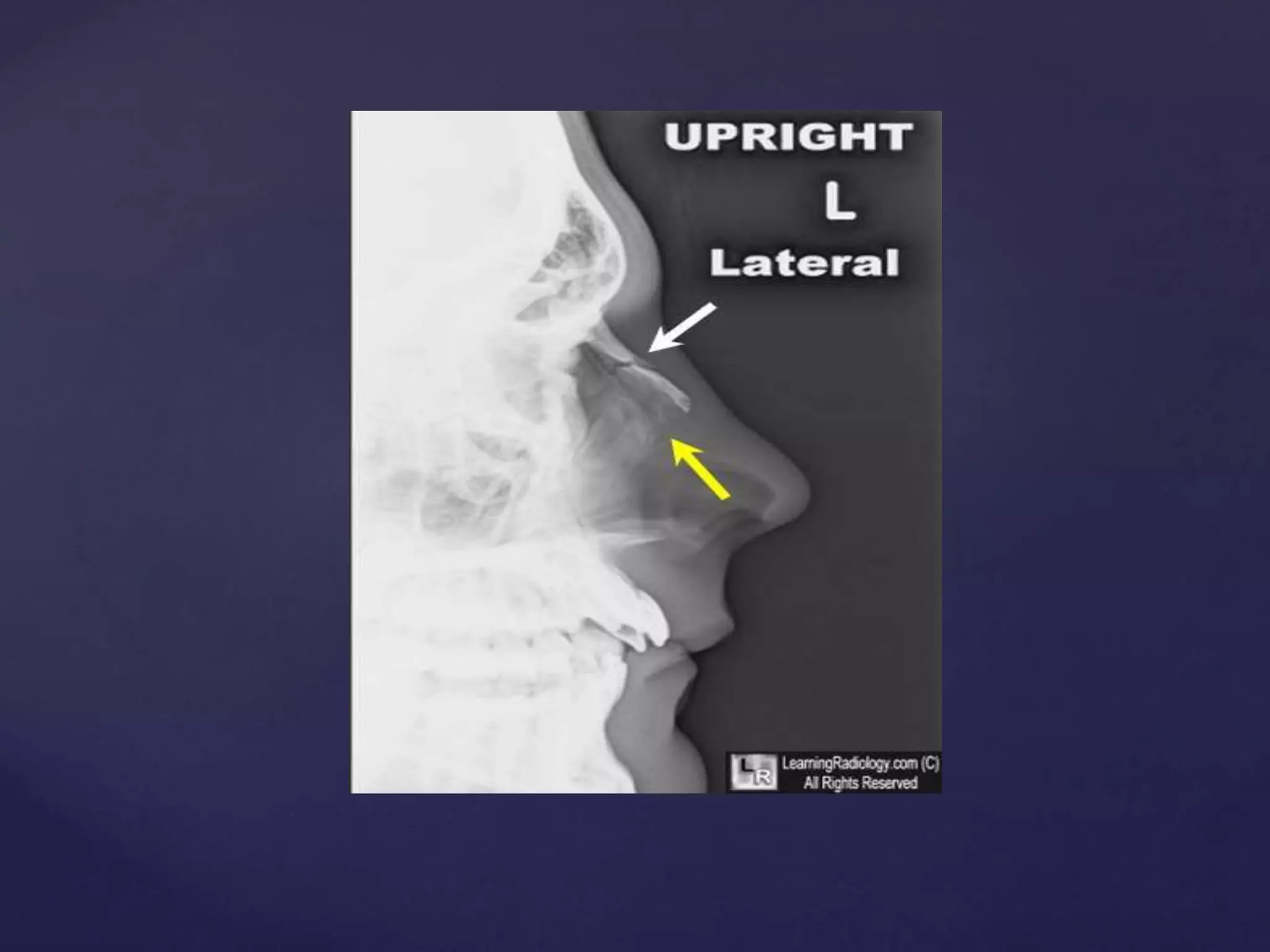 X rays in ent | PPTX