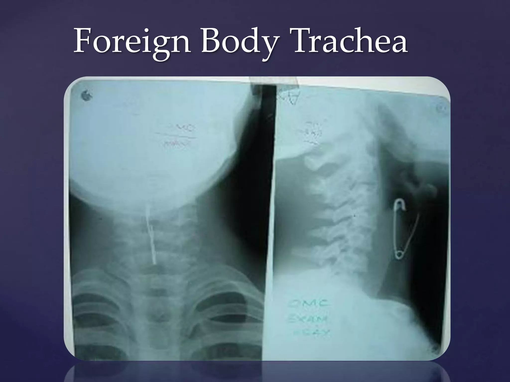 X rays in ent | PPTX