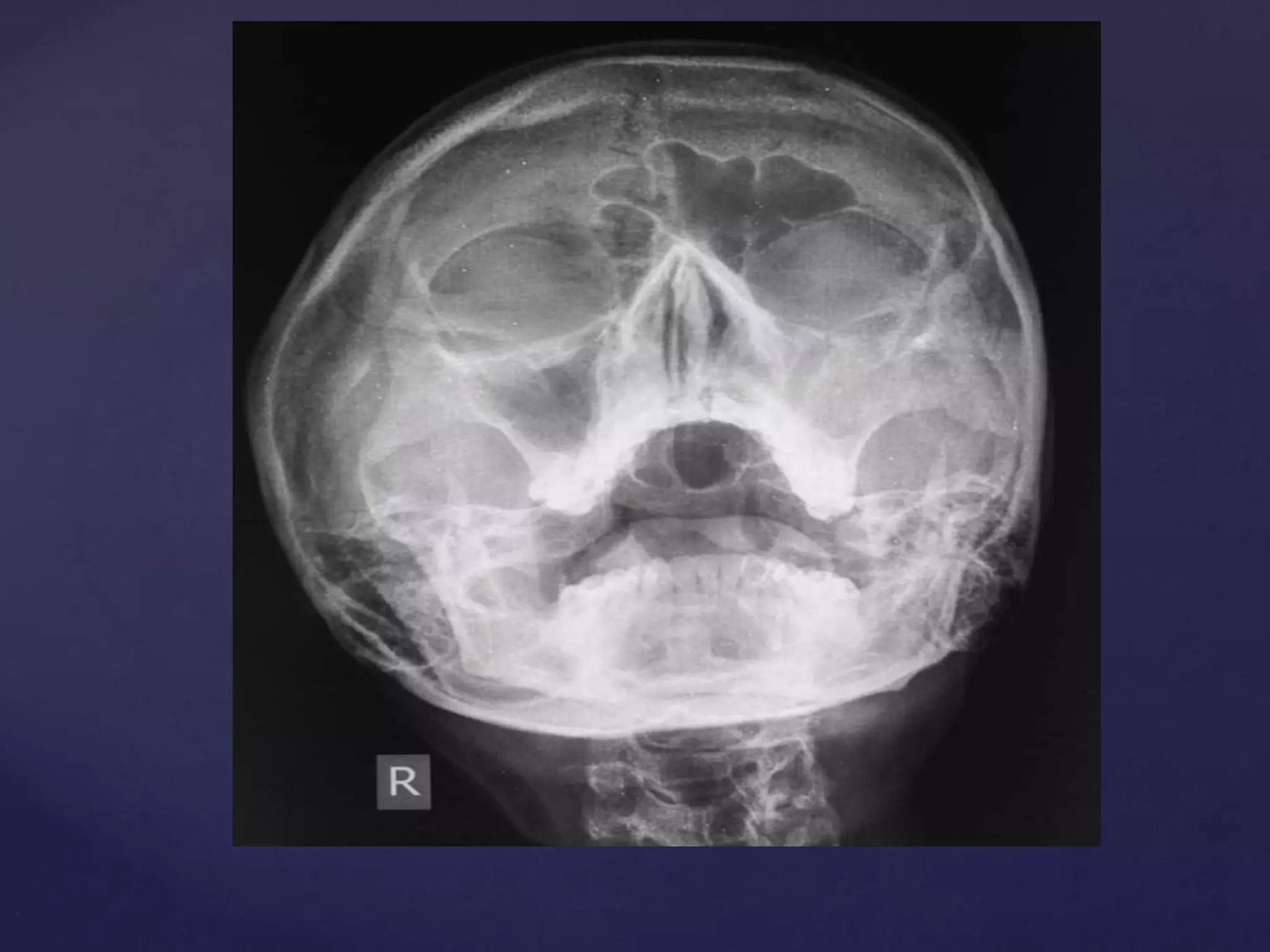 X rays in ent | PPTX