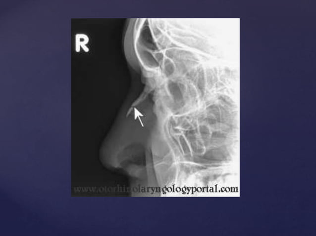 X rays in ent | PPTX | Ear, Nose and Throat Conditions | Diseases and Conditions