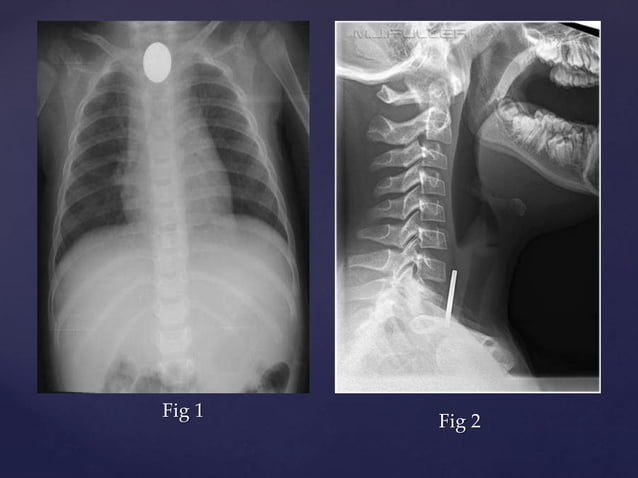 X rays in ent | PPTX | Ear, Nose and Throat Conditions | Diseases and ...