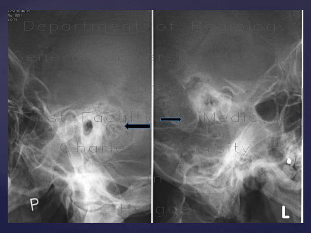 X rays in ent | PPTX | Ear, Nose and Throat Conditions | Diseases and ...