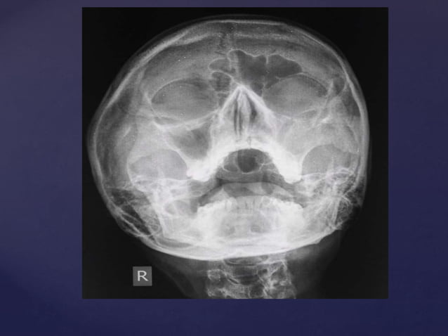 X rays in ent | PPTX | Ear, Nose and Throat Conditions | Diseases and Conditions