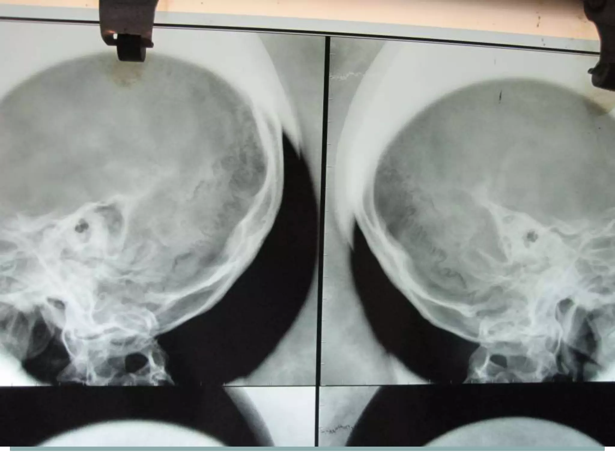 Xrays in ent- Dr Ashly Alexander | PPTX