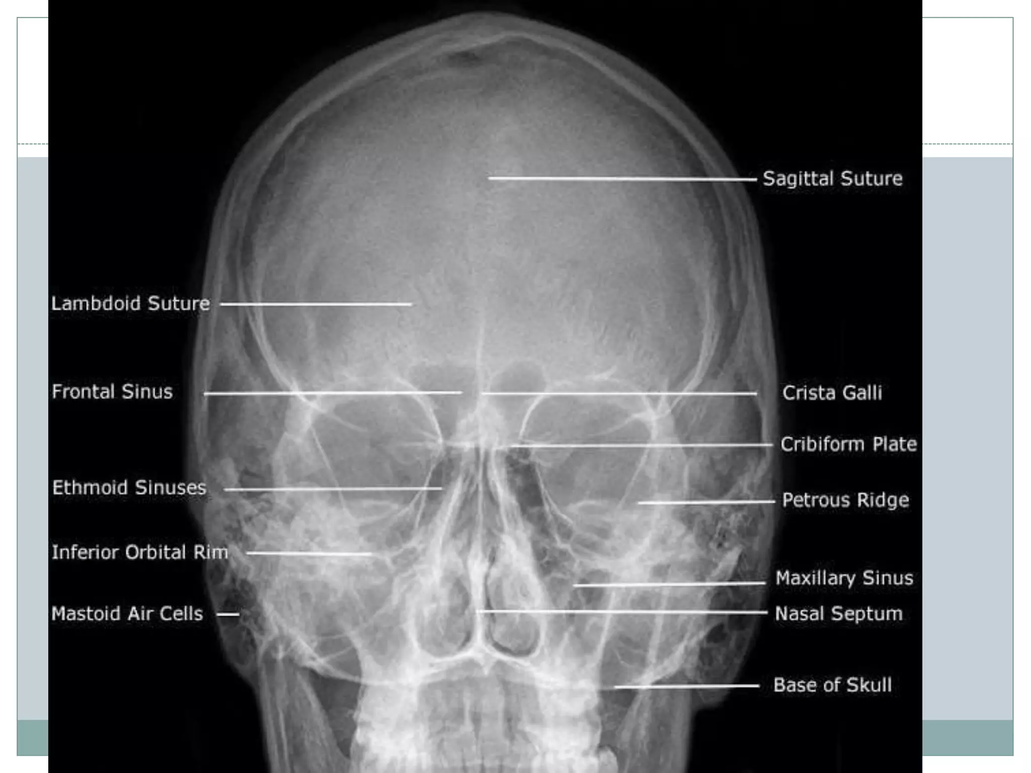 Xrays in ent- Dr Ashly Alexander | PPTX