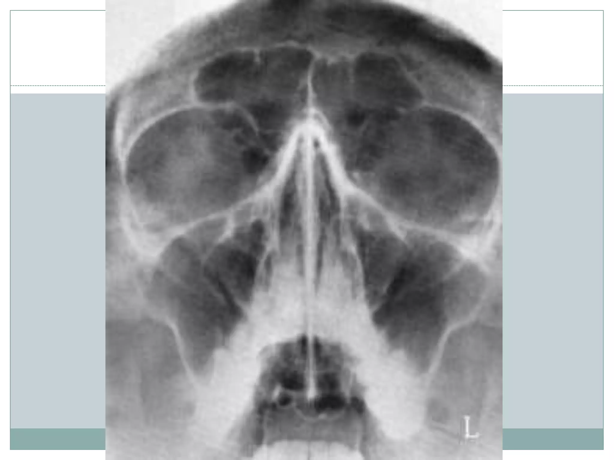 Xrays in ent- Dr Ashly Alexander | PPTX
