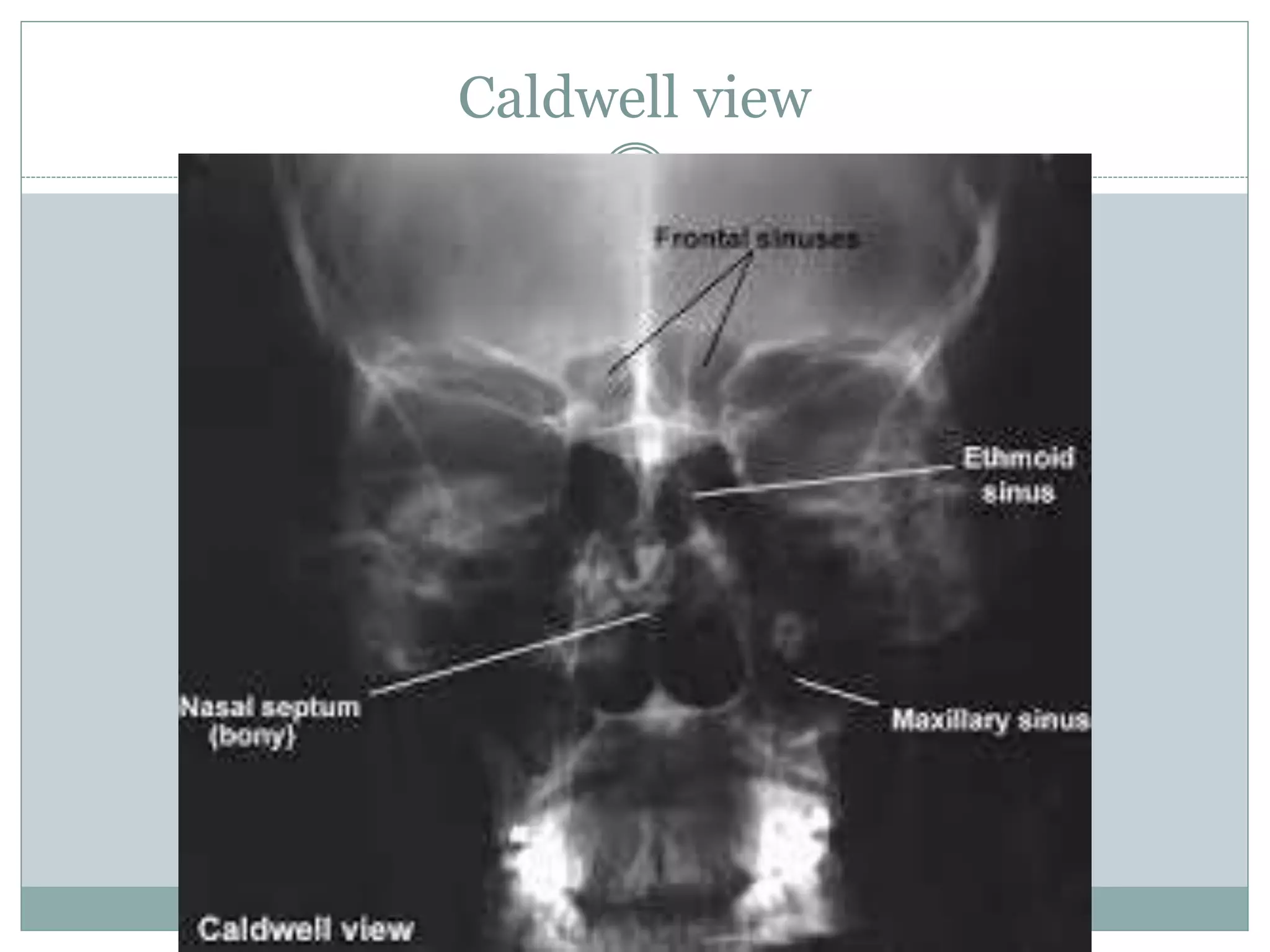 Xrays in ent- Dr Ashly Alexander | PPTX