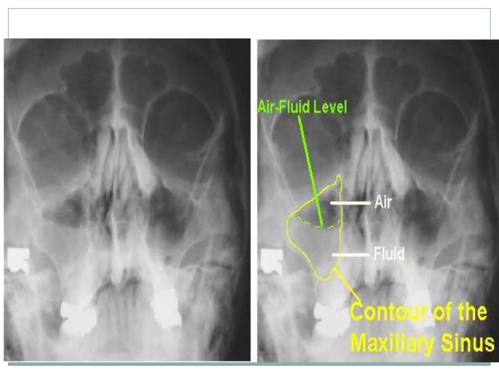 Xrays in ent- Dr Ashly Alexander | PPTX