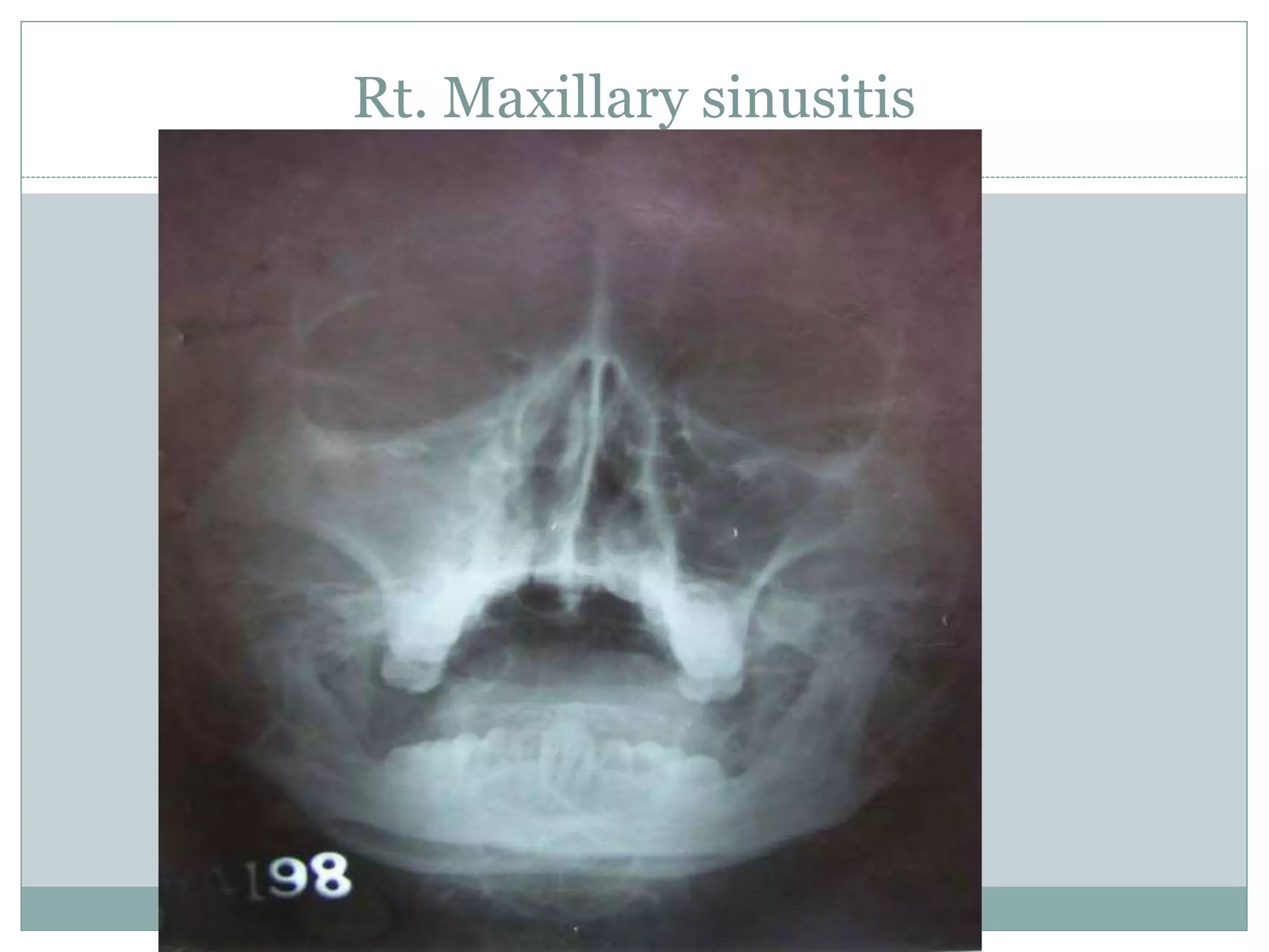 Xrays in ent- Dr Ashly Alexander | PPTX