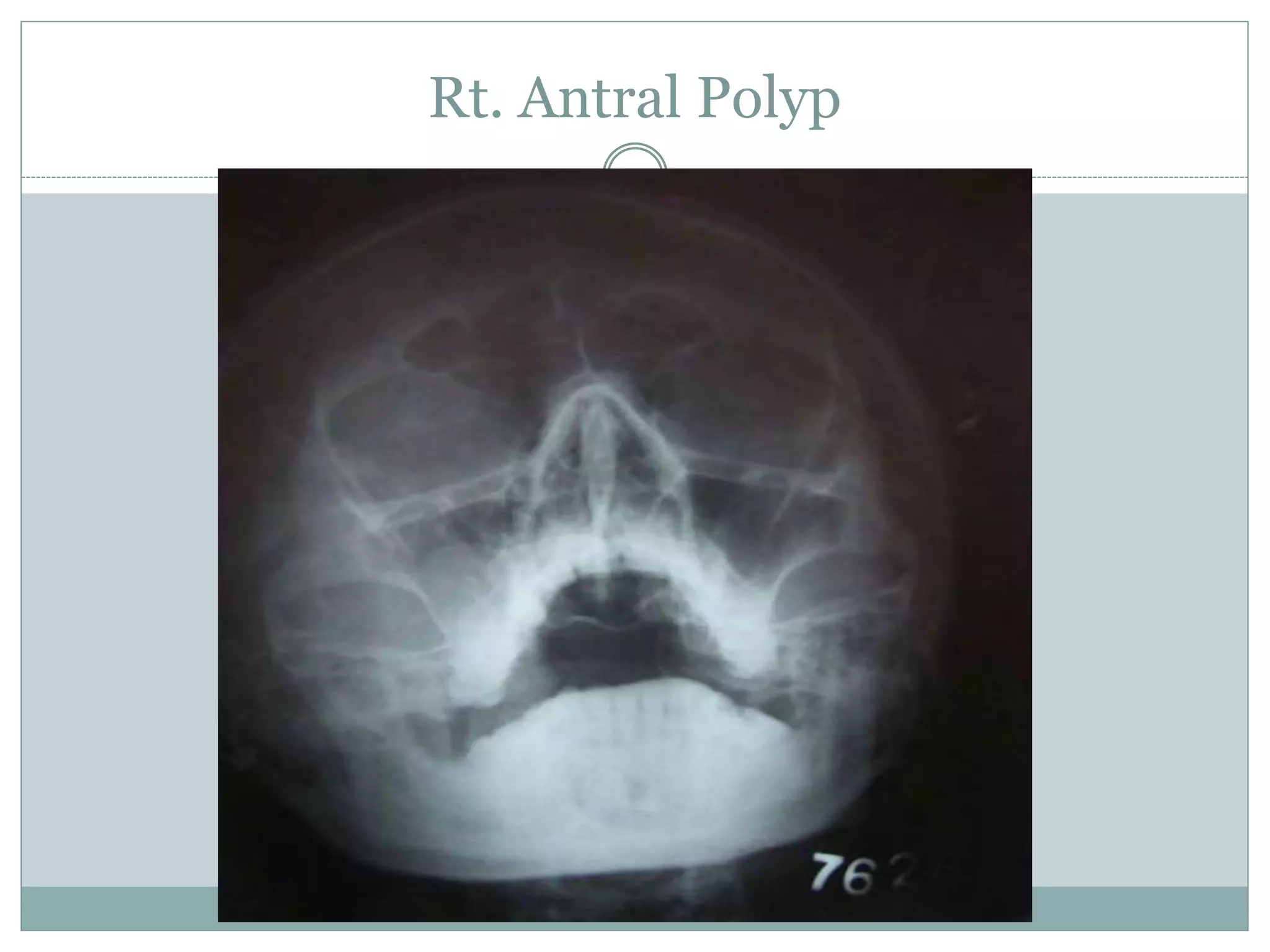 Xrays in ent- Dr Ashly Alexander | PPTX