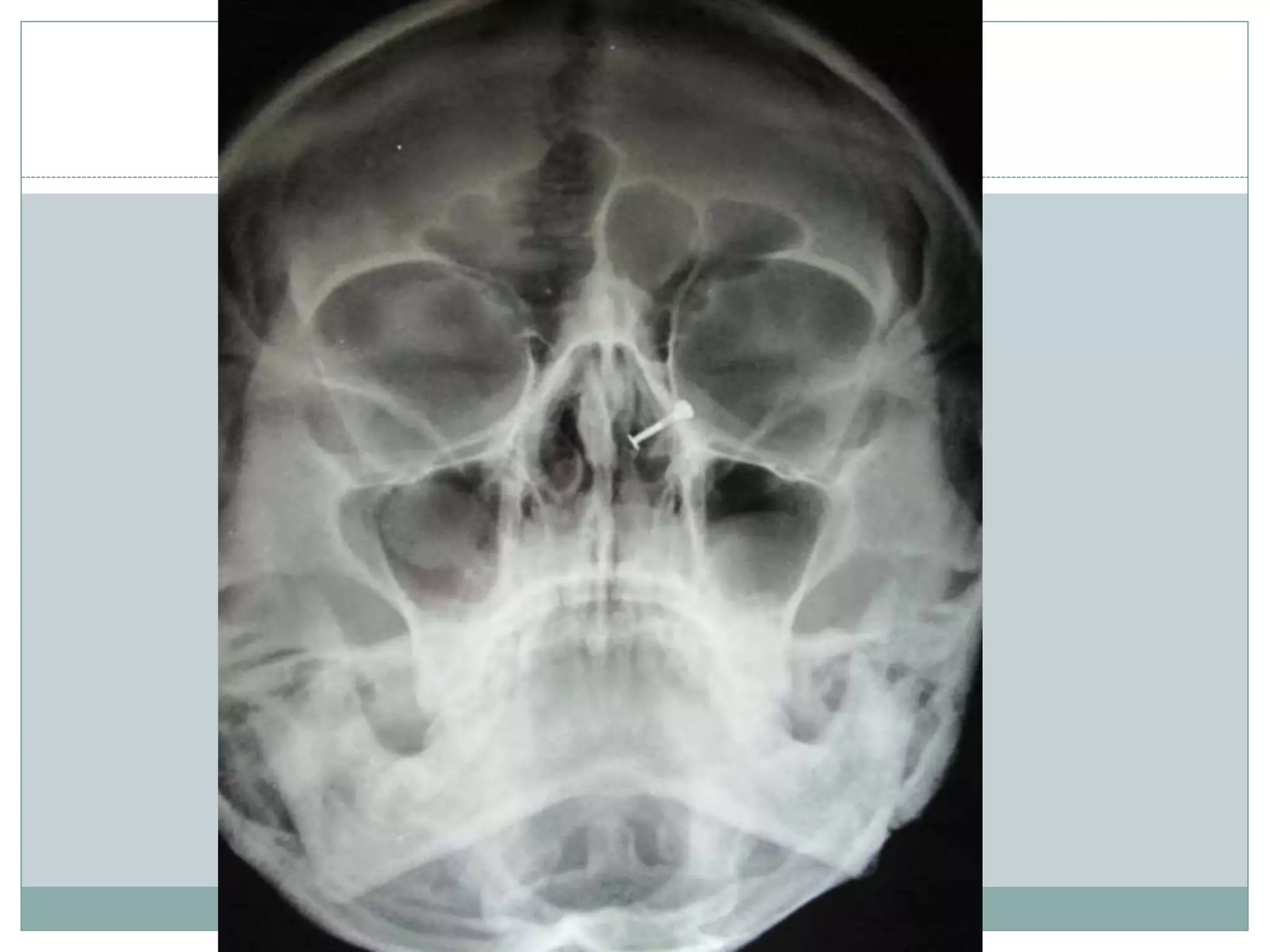 Xrays in ent- Dr Ashly Alexander | PPTX