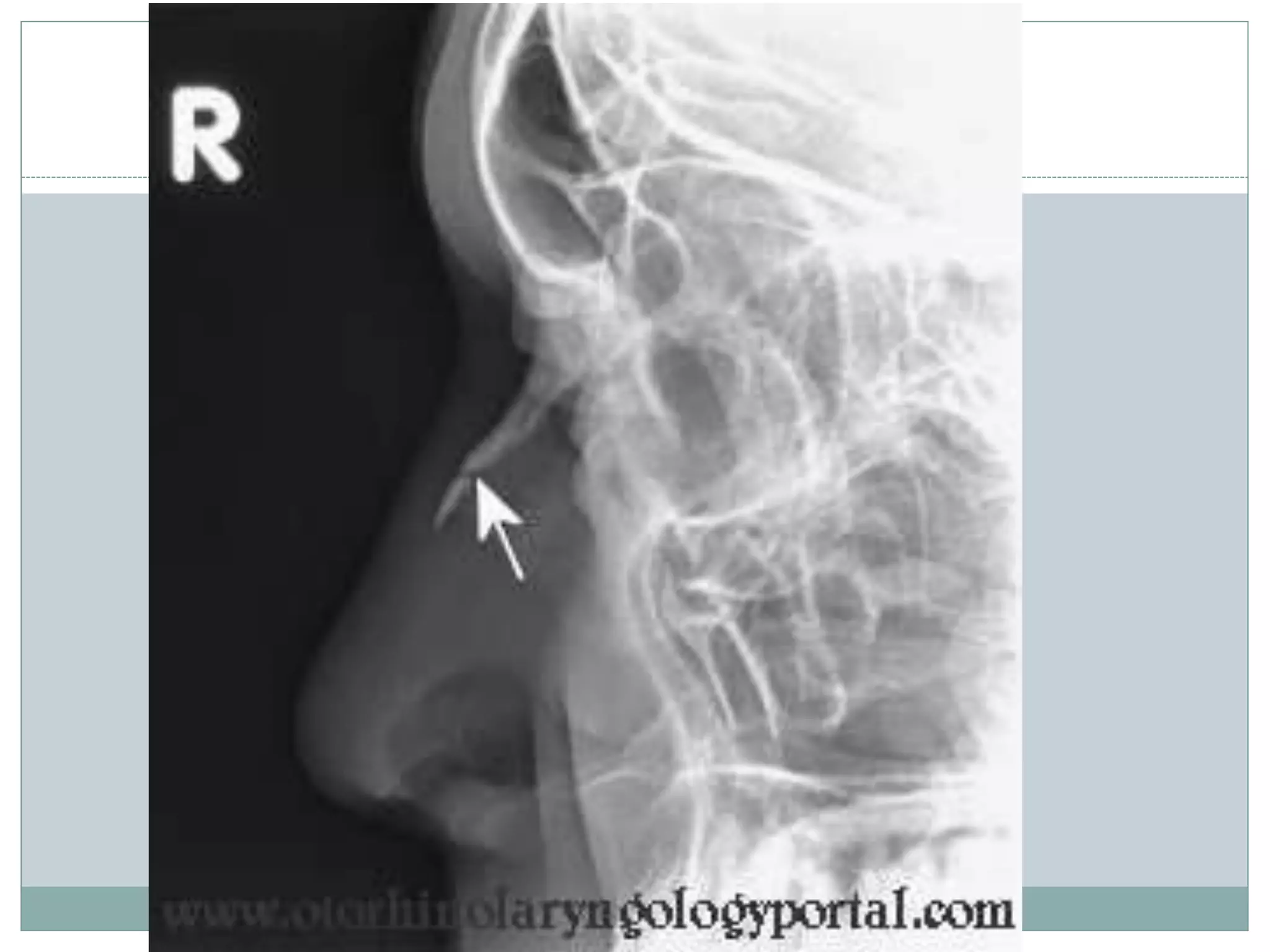 Xrays in ent- Dr Ashly Alexander | PPTX