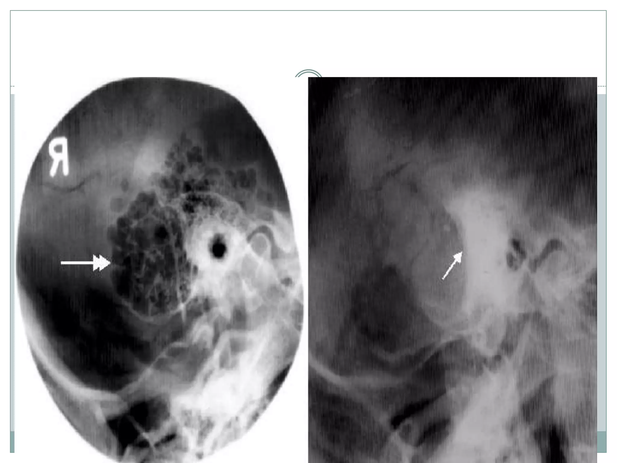 Xrays in ent- Dr Ashly Alexander | PPTX