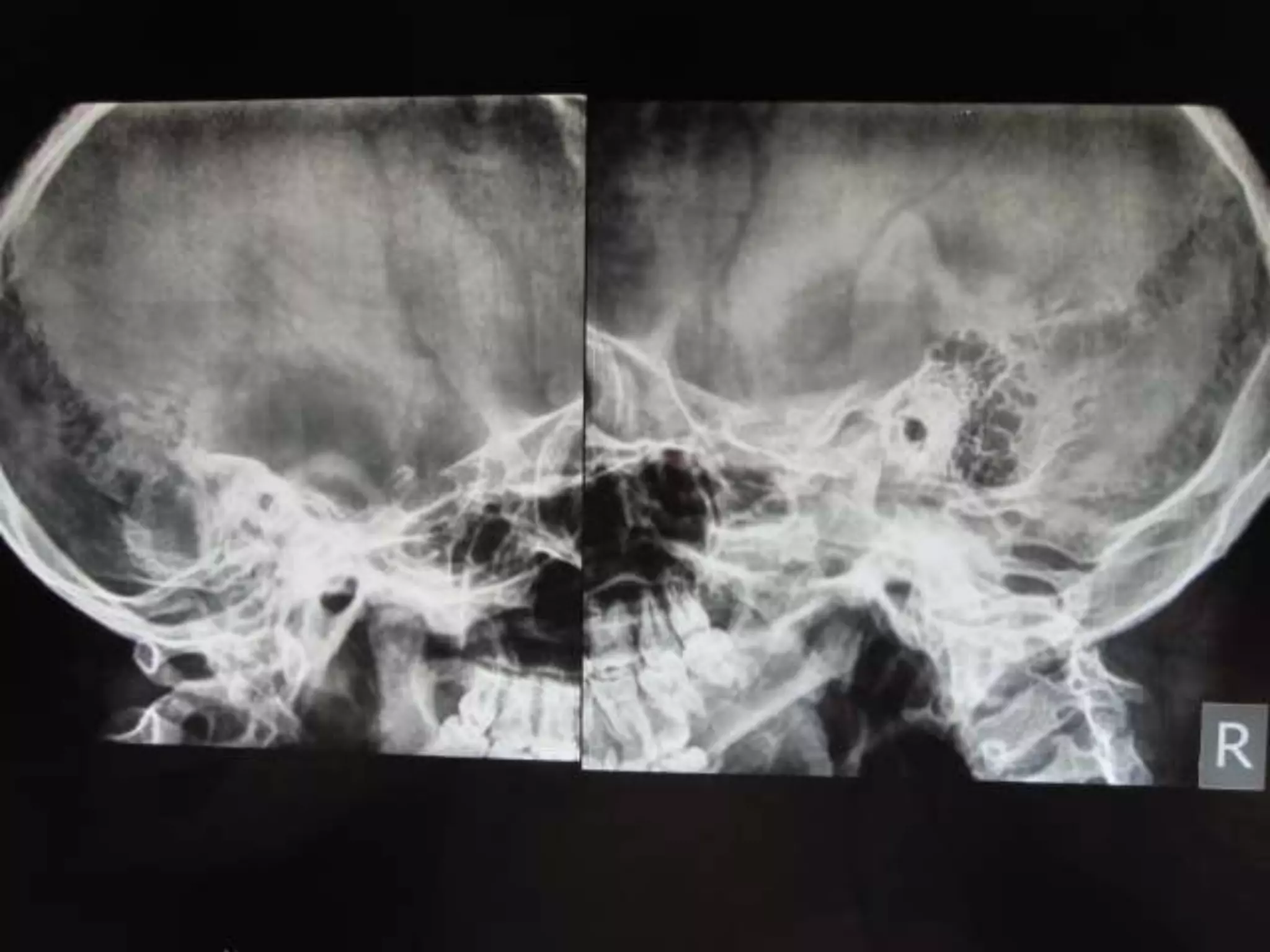 Xrays in ent- Dr Ashly Alexander | PPTX