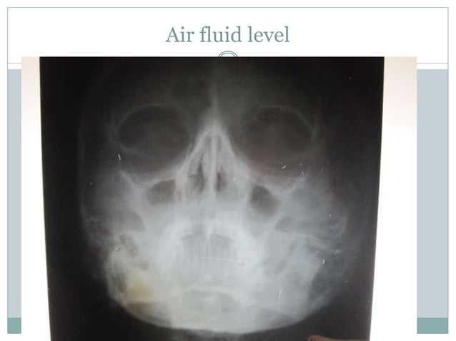 Xrays in ent- Dr Ashly Alexander | PPTX
