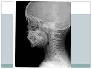 Xrays in ent- Dr Ashly Alexander | PPTX