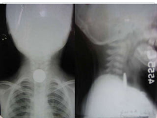 Xrays in ent- Dr Ashly Alexander | PPTX