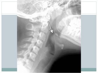 Xrays in ent- Dr Ashly Alexander | PPTX
