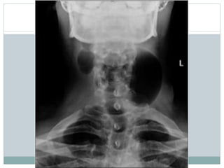 Xrays in ent- Dr Ashly Alexander | PPTX