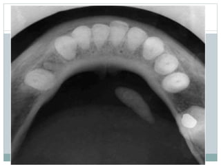 Xrays in ent- Dr Ashly Alexander | PPTX
