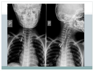 Xrays in ent- Dr Ashly Alexander | PPTX