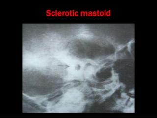Mastoiditis X Ray