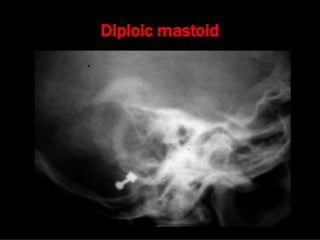 Mastoiditis X Ray