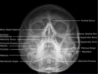 Mastoiditis X Ray