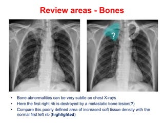 CHEST XRAYS SYSTEMATIC APPROACH,,,,,,,,, | PPTX | Lung and Respiratory ...