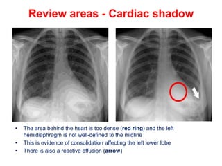CHEST XRAYS SYSTEMATIC APPROACH,,,,,,,,, | PPTX | Lung and Respiratory ...