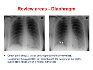 CHEST XRAYS SYSTEMATIC APPROACH,,,,,,,,, | PPTX | Lung and Respiratory ...