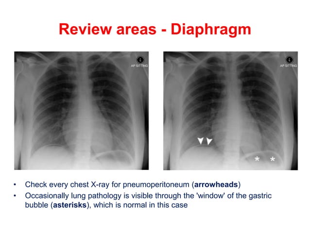 CHEST XRAYS SYSTEMATIC APPROACH,,,,,,,,, | PPTX | Lung and Respiratory ...