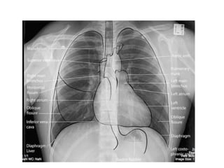 CHEST XRAYS SYSTEMATIC APPROACH,,,,,,,,, | PPTX | Lung and Respiratory Health | Diseases and ...