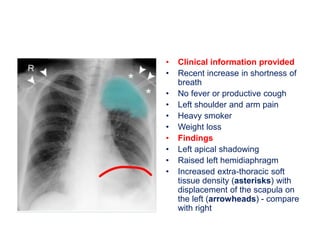 CHEST XRAYS SYSTEMATIC APPROACH,,,,,,,,, | PPTX | Lung and Respiratory ...