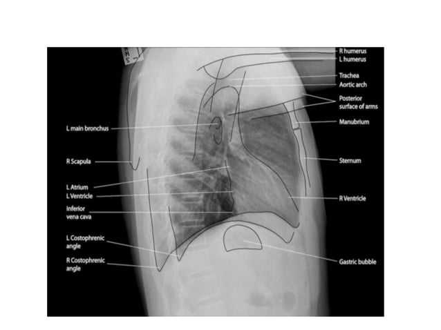 CHEST XRAYS SYSTEMATIC APPROACH,,,,,,,,, | PPTX | Lung and Respiratory ...