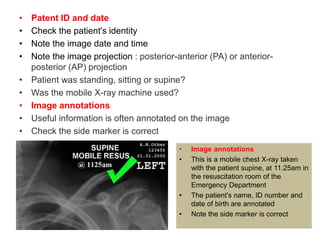 CHEST XRAYS SYSTEMATIC APPROACH,,,,,,,,, | PPTX | Lung and Respiratory ...