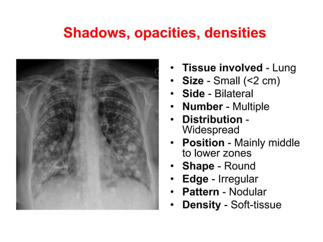 CHEST XRAYS SYSTEMATIC APPROACH,,,,,,,,, | PPTX | Lung and Respiratory ...