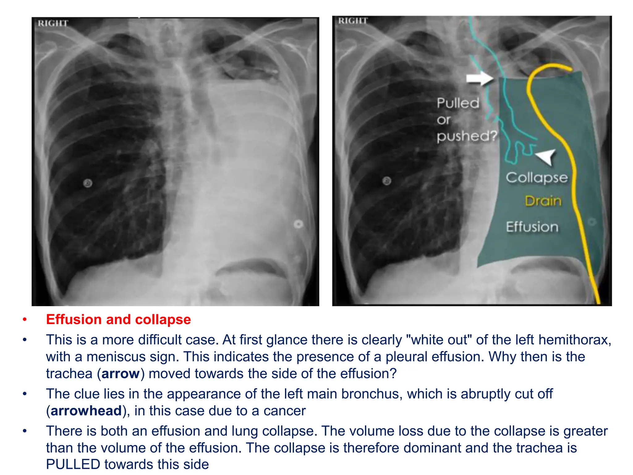 CHEST XRAYS STEP BY STEP APPROACH,,.pptx