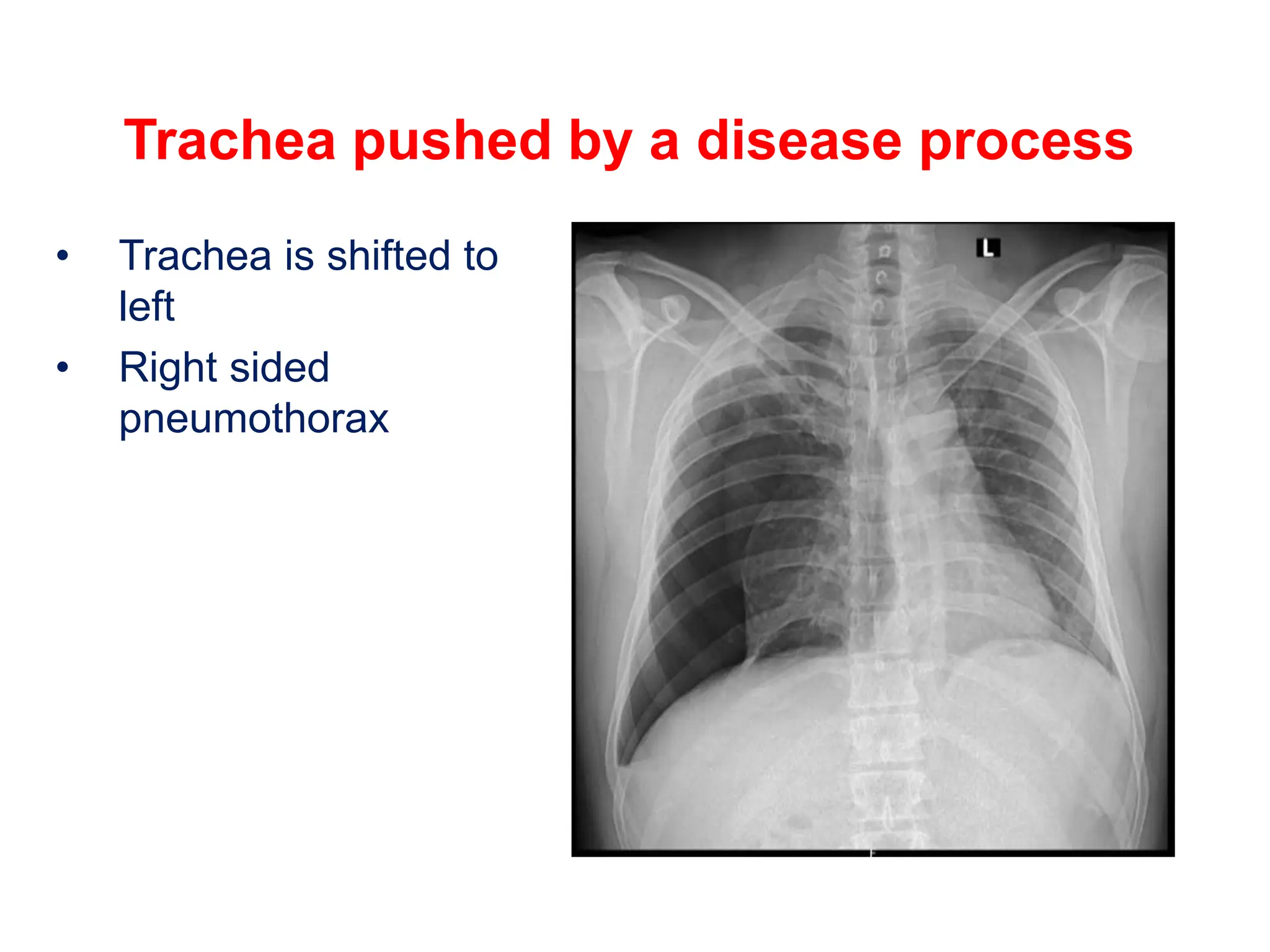CHEST XRAYS STEP BY STEP APPROACH,,.pptx