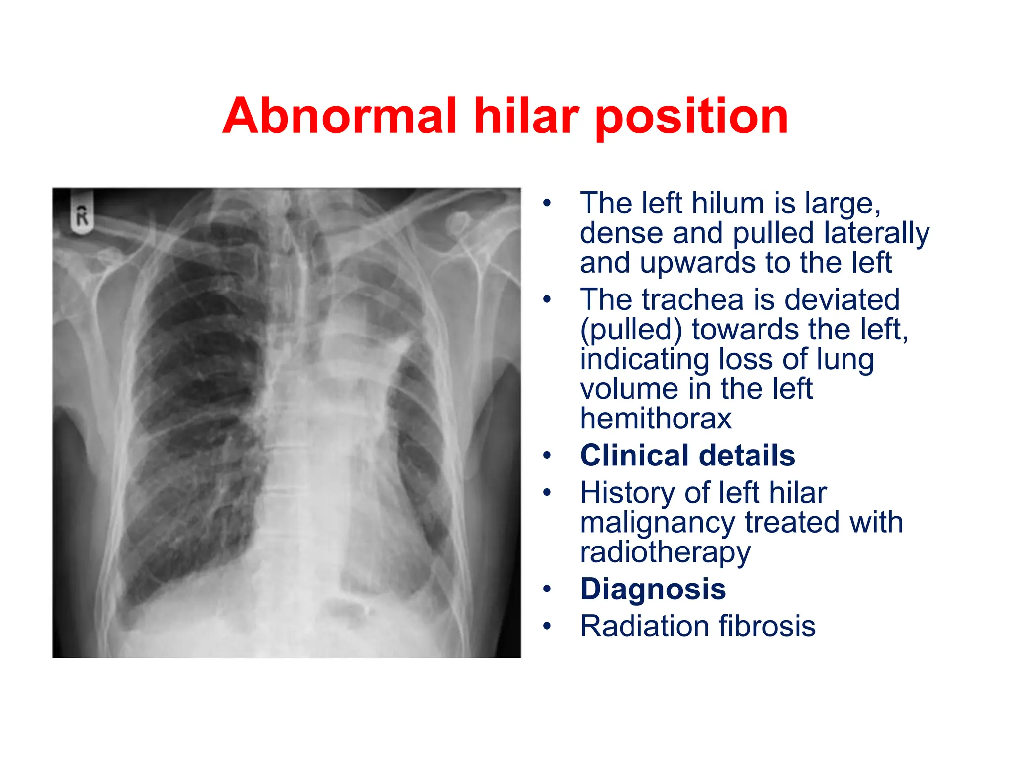 CHEST XRAYS STEP BY STEP APPROACH,,.pptx
