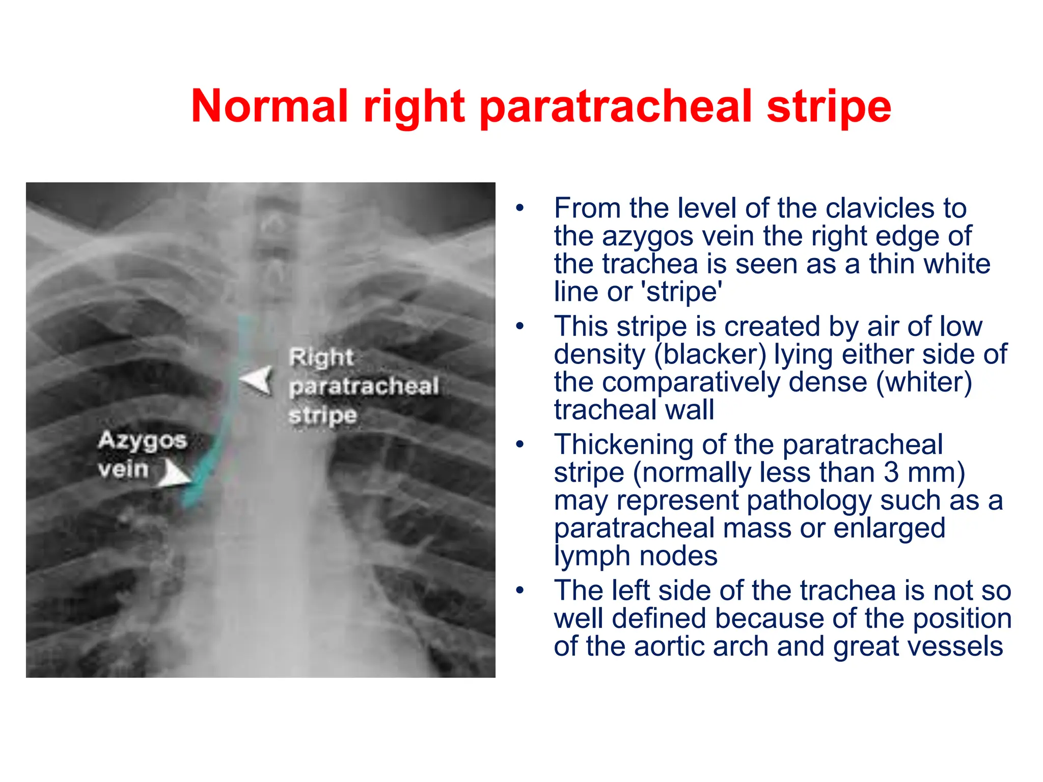 CHEST XRAYS STEP BY STEP APPROACH,,.pptx