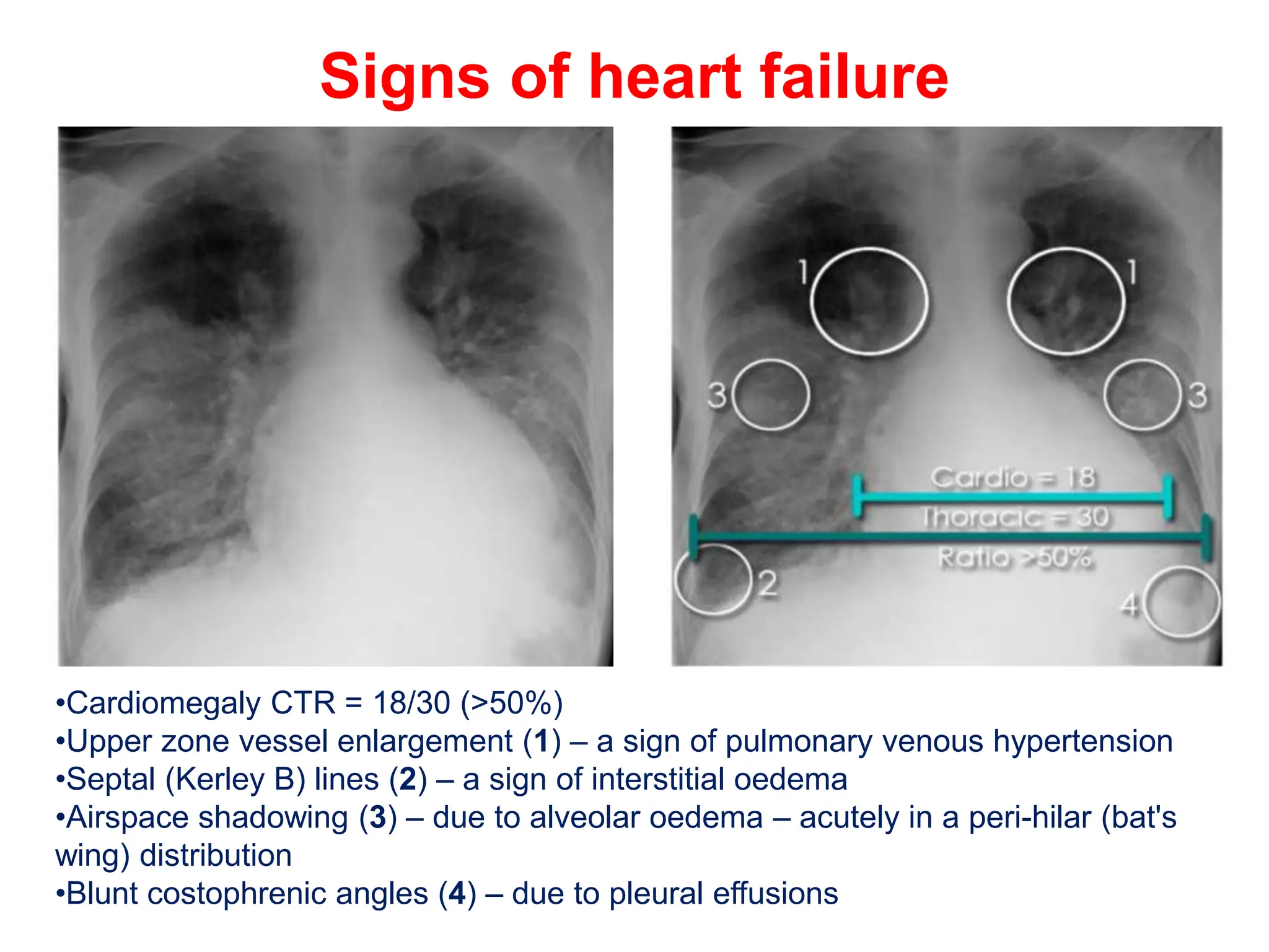 CHEST XRAYS STEP BY STEP APPROACH,,.pptx