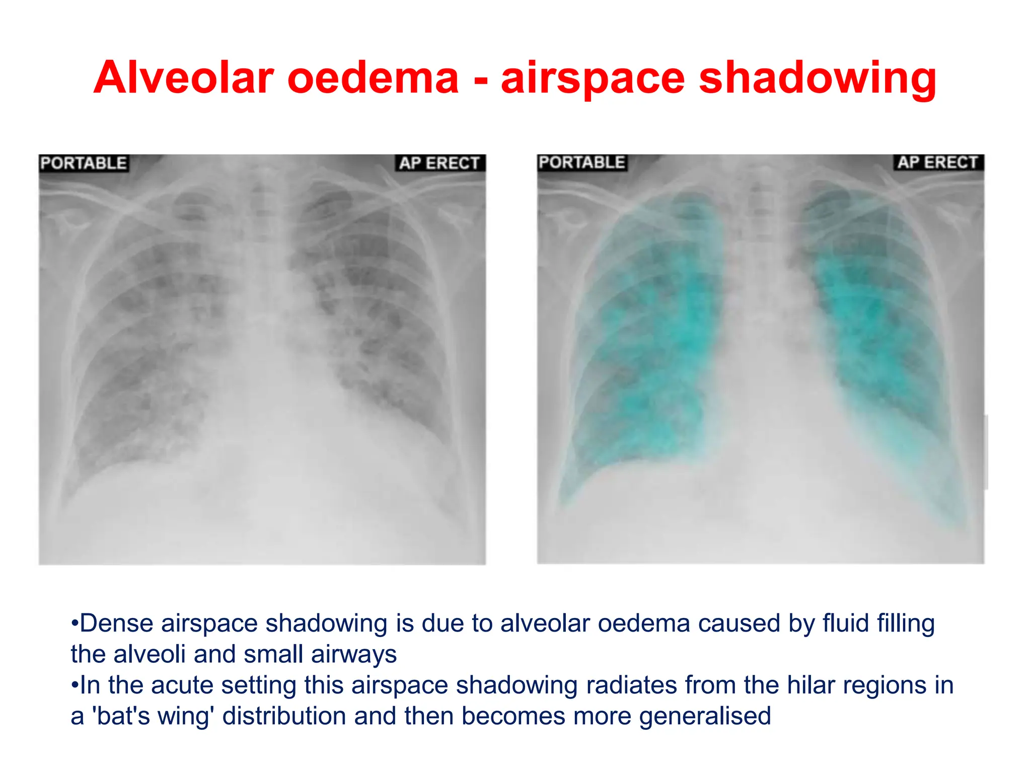 CHEST XRAYS STEP BY STEP APPROACH,,.pptx