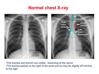 CHEST XRAYS STEP BY STEP APPROACH,,.pptx